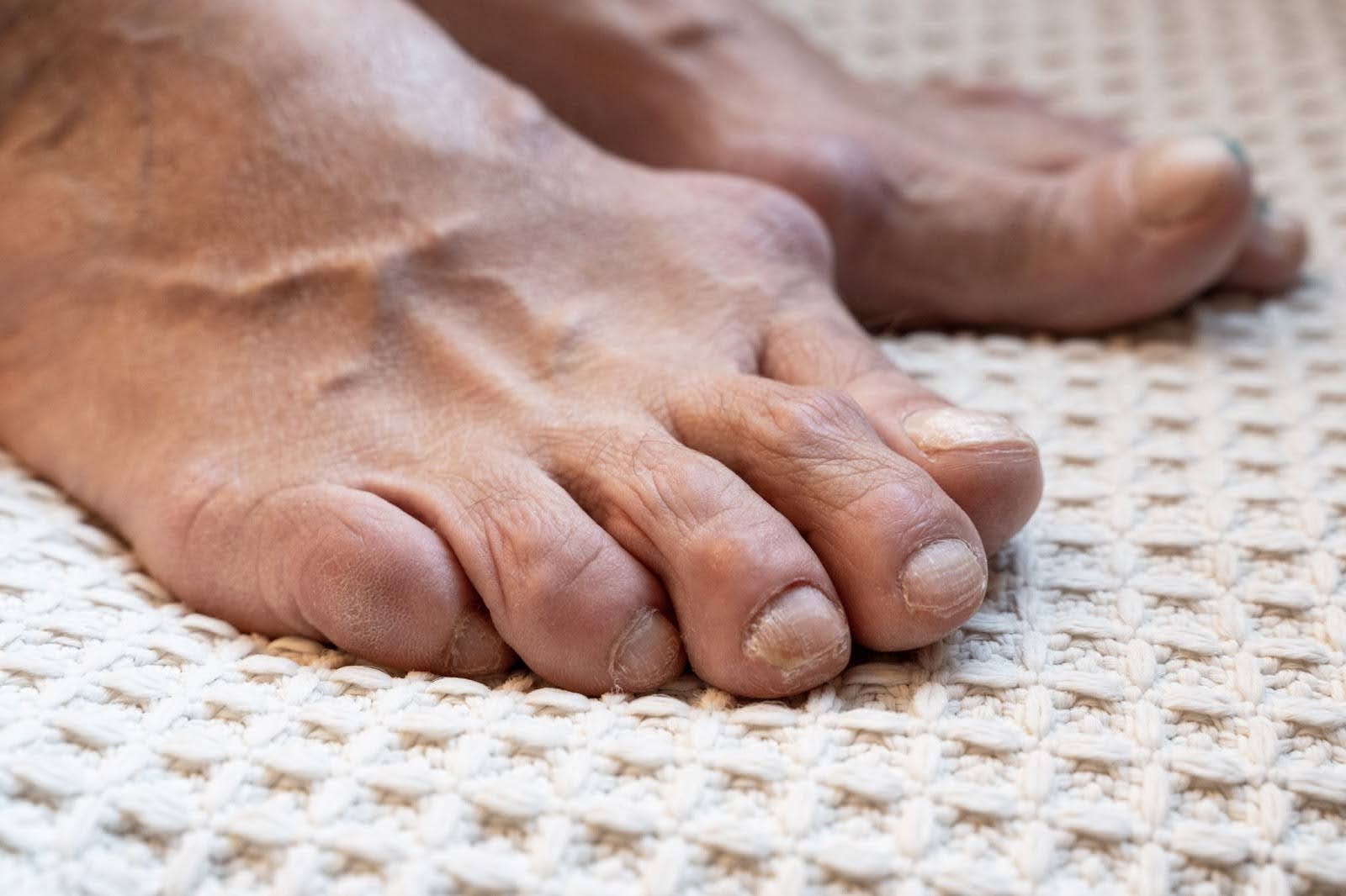 Is Gout Visible? Signs to Look For – Juvent