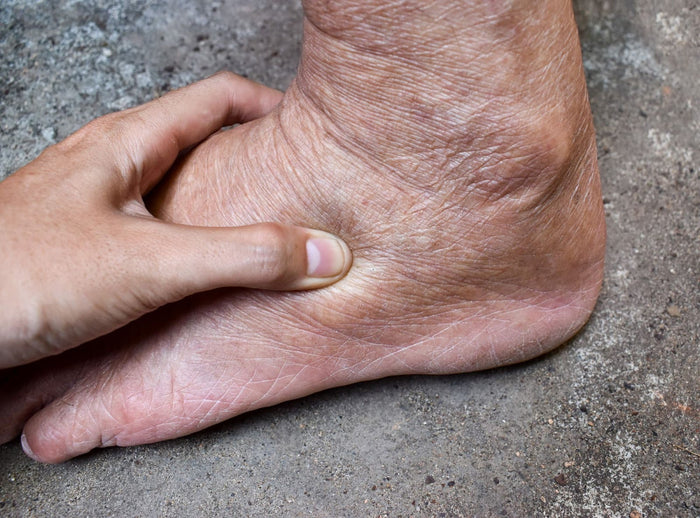 Who Is Prone to Edema and Why? – Juvent
